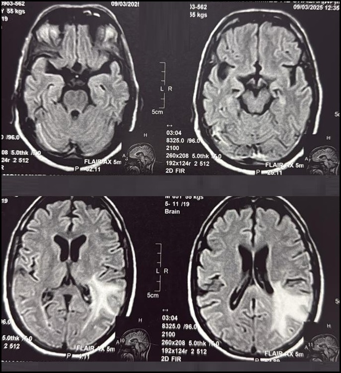 Diffuse Midline Glioma (DMG) Brain Tumor Surgery in India | Satyug ...